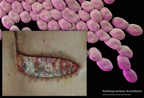 Multidrug Resistant Organisms Mdros Growing Spreading And Killing