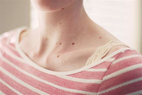 Spot The Differences Between A Mole And Skin Cancer