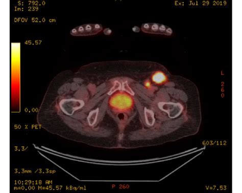 Hypermetabolic Left Inguinal Lymphadenopathy Download Scientific Diagram
