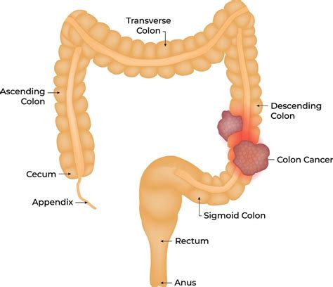 Appendectomy Appendicitis Anatomy Design Illustration 54989711 Vector Art At Vecteezy