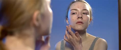 Sivilceli Cildin Bakımında Dikkat Edilmesi Gereken Tedavi