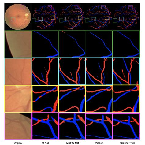 Figure 1 From Automatic Artery Vein Classification Using A Vessel Constraint Network For