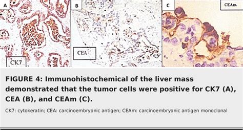 [pdf] Intrahepatic Cholangiocarcinoma With Lung Metastasis In A 29 Year Old Male Patient A Case