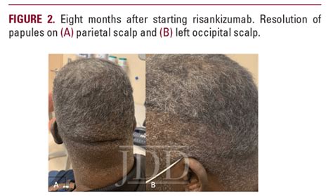 Refractory Dissecting Cellulitis Of The Scalp Treated With Risankizumab Figure2 Next Steps In