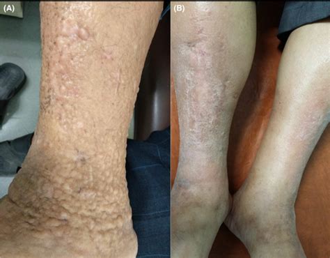 Pretibial Myxedema In Graves Disease A Case Report And Treatment