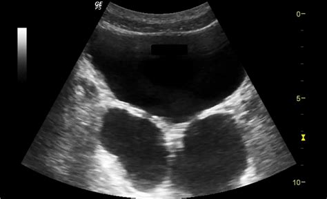 Using Point Of Care Ultrasound For Bladder Diagnosis