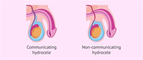 Spermatocele Vs Hydrocele