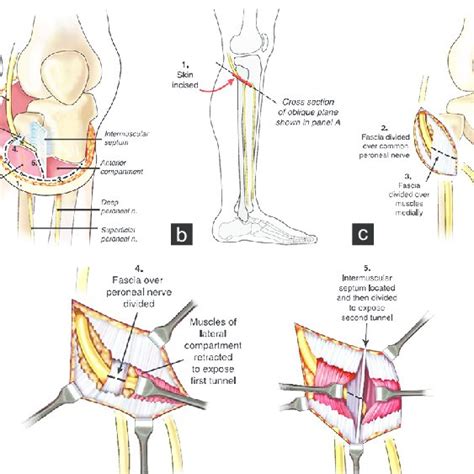 Pdf Surgical Decompression Of The Peroneal Nerve In The Correction Of