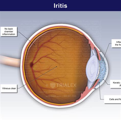 Medical Legal Exhibits Legal Animations And Trial Graphics Tria