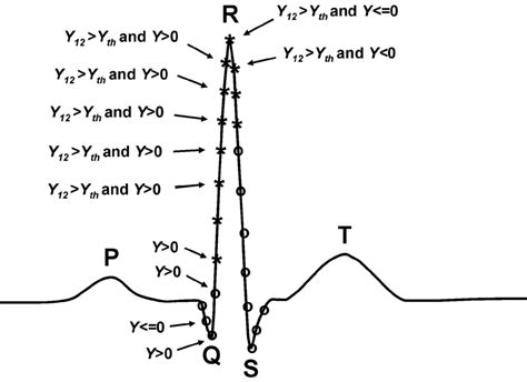The Conditions For Detection Of R And Q Wave For R Wave Detection The Download Scientific