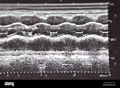 Cardiac Ultrasound Echocardiography A Medical Imaging Using The Ultrasound To Examine The