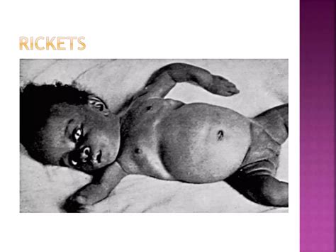 Rickets Clinical Features Pptx