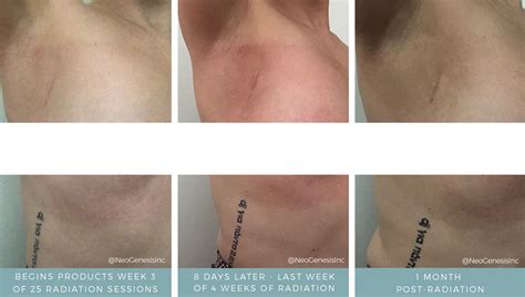 Radiation Side Effects Breast Cancer Treatment