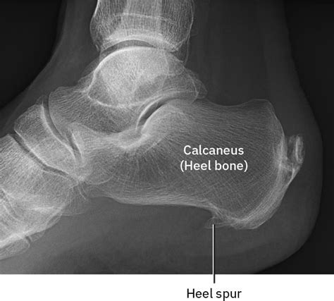 13 2 Osteoarthritis Medicine Libretexts