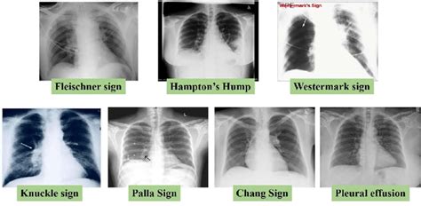Different Radio Graphical Signs On Chest X Ray Of Pe Download