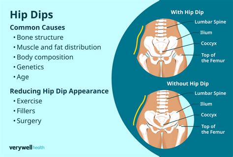 Hip Dips And What You Can Do About Them