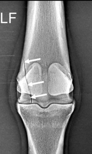 Joints 1 Intra Articular Fractures Flashcards Quizlet