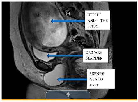 Symptomatic Giant Skenes Gland Cyst During Second Trimester Pregnancy