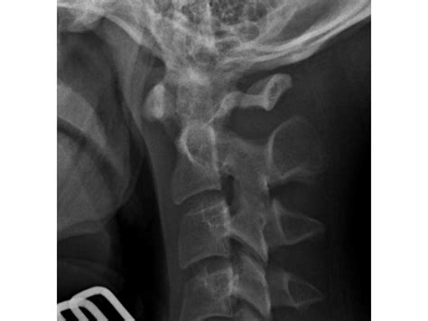 Cervical Fracture And Injuries Presentation Ppt