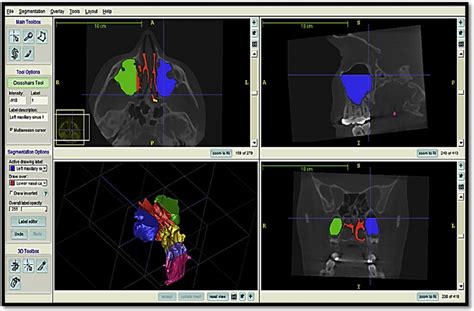 E Segmentation Procedure Using Itk Snap Software Download Scientific Diagram