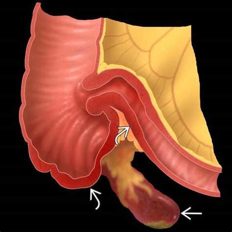 Appendicitis Radiology Key