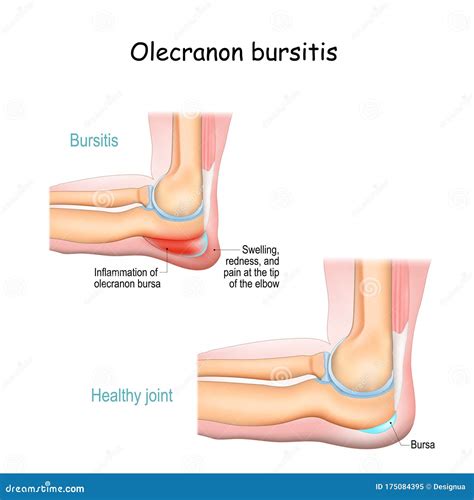 Student Elbow Bursitis Cartoon Vector 222222021