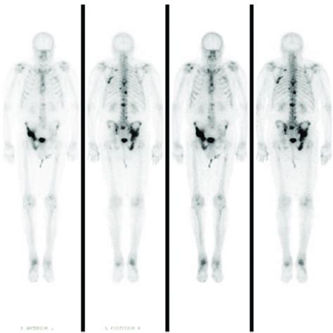 Technetium 99 M Bone Scan Demonstrating Metastasis In The Spine And