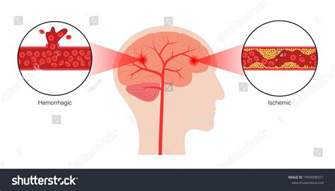 뇌출혈 1007개가 넘는 로열티 프리 라이선스 대상 스톡 벡터 및 벡터 아트 Shutterstock