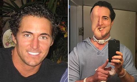 Synovial Sarcoma Man Left With Half A Face After Cancer Daily Mail Online