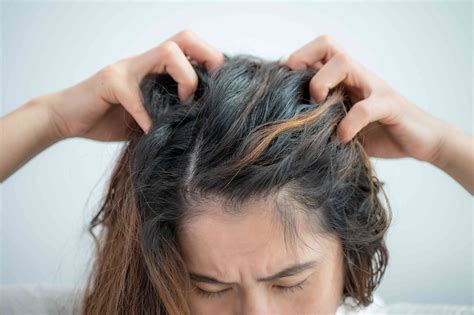 Lice Vs Dandruff How To Tell The Difference