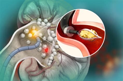 上海那个肾结石医院治疗的好 上海宏康医院 39就医助手