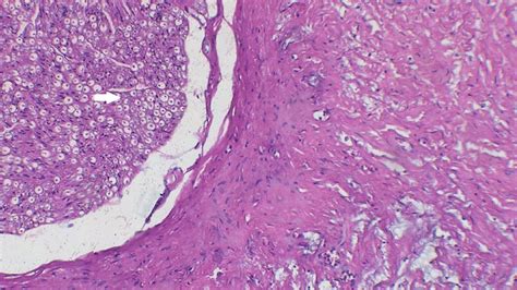 Fibrillar Proliferation With A Schwannian Pattern Next To A Nerve Download Scientific Diagram