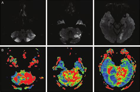 A Initial Brain Diffusion Weighted MRI Shows Diffusion Restriction In Download Scientific