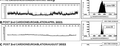 Figure 3 From Carotid Sinus Syndrome Treated By Cardioneuroablation Is