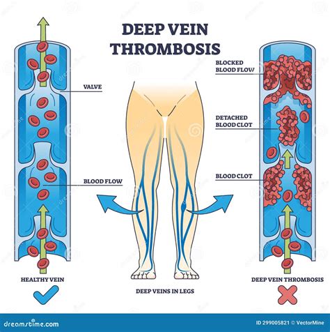 Deep Vein Thrombosis Condition With Blood Clot Blockage Outline Diagram