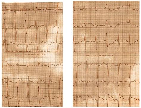 Ecg Deep Q Waves And T Waves Inversions In Leads I Avl And Deep Q Download Scientific Diagram