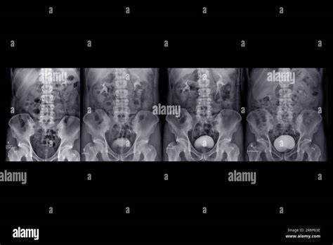 Intravenous Pyelogram Or I V P Is An X Ray Exam Of Urinary Tract After Injection Contrast Media