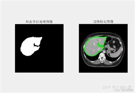 ﻿基于matlab的区域生长肝影像医学图像分割 种子点选取，区域生长图像分割，形态学处理，边缘检测标记，完整代码 知乎