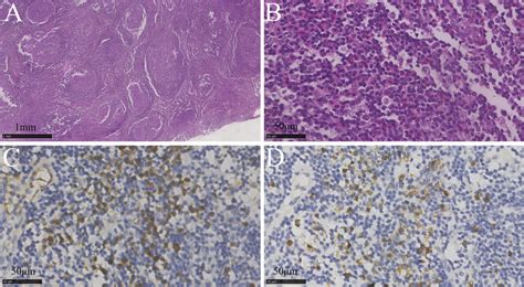 Pathologic Histology Of The Resected Right Submandibular Mass A B
