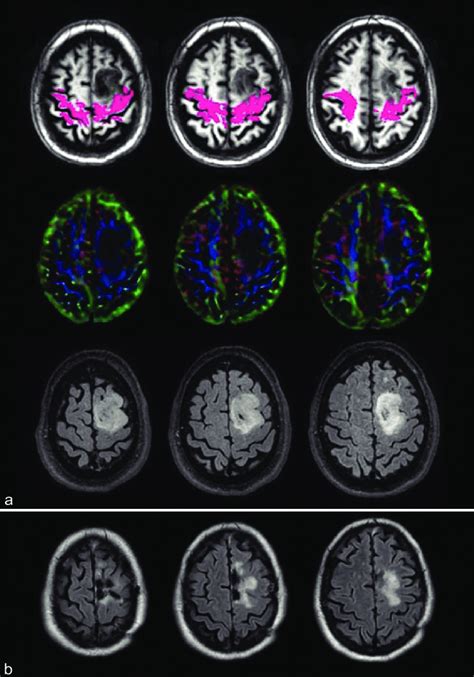 Diffusion Tensor Tractography Of A Patient With Left Frontal