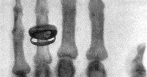 X선 발견 125년 만에 아날로그에서 디지털 촬영 가능해진다