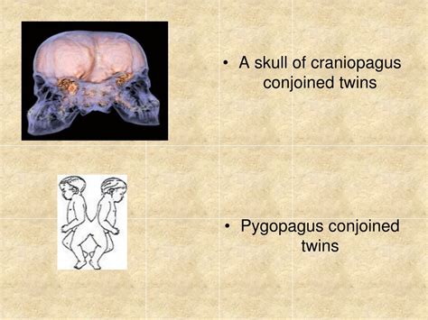 Ppt Understanding Conjoined Twins Types Considerations And Case