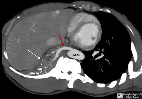 Learning Radiology Bronchopulmonary Sequestration