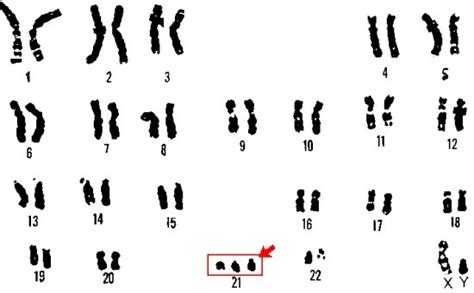 What Is The Difference Between Karyotype And Karyogram Pediaacom
