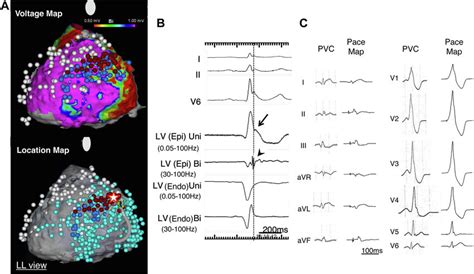 A Epicardial Bipolar Voltage Upper And Location Map Lower Of The Download Scientific