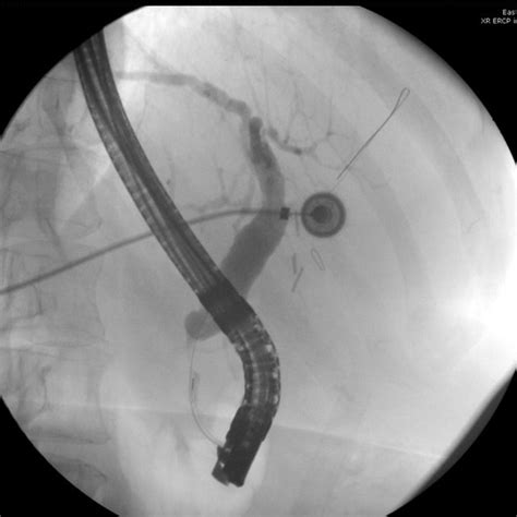 Cholangiogram Obtained During Cholecystectomy Showing Prominent Common