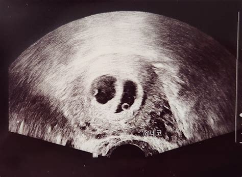 시험관임신6주차 6주 1일차 쌍둥이 난황확인 심장소리 확인 아기집 추가 확인 네이버 블로그