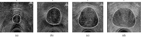 Examples Of Trus Prostate Segmentation The Solid Contours Are The Download High Resolution