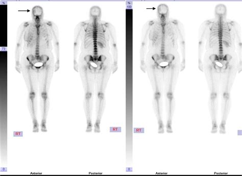 whole body bone scan showing skull uptake black arrow download