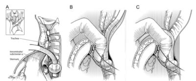Management Tracheostomy Bleeding RCEMLearning India